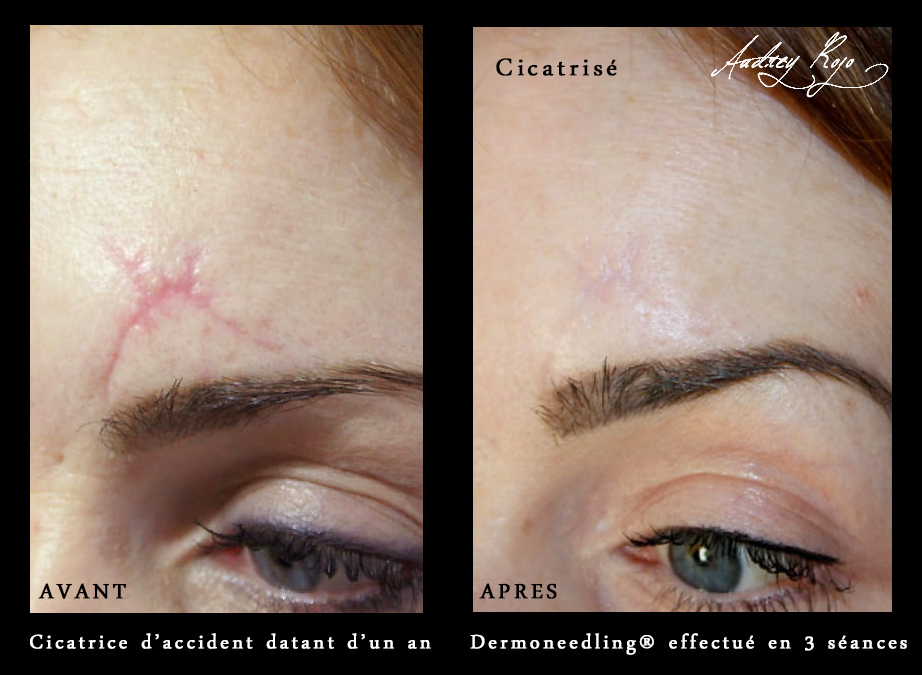 Le Dermoneedling® : cicatrices – brûlures – vergetures